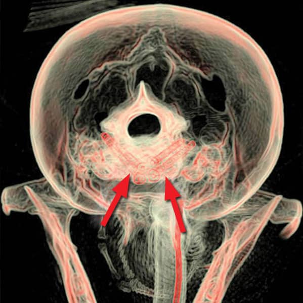 Atlanto-axial Subluxation - NDSR