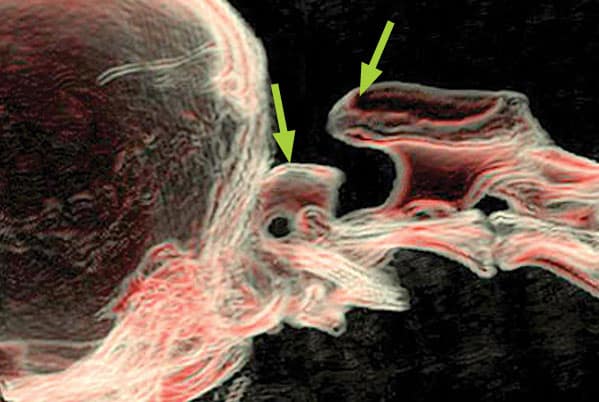 Atlanto-axial Subluxation - NDSR