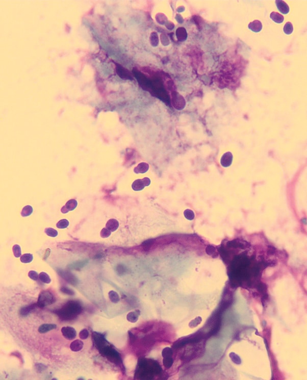 Malassezia Dermatitis | NDSR