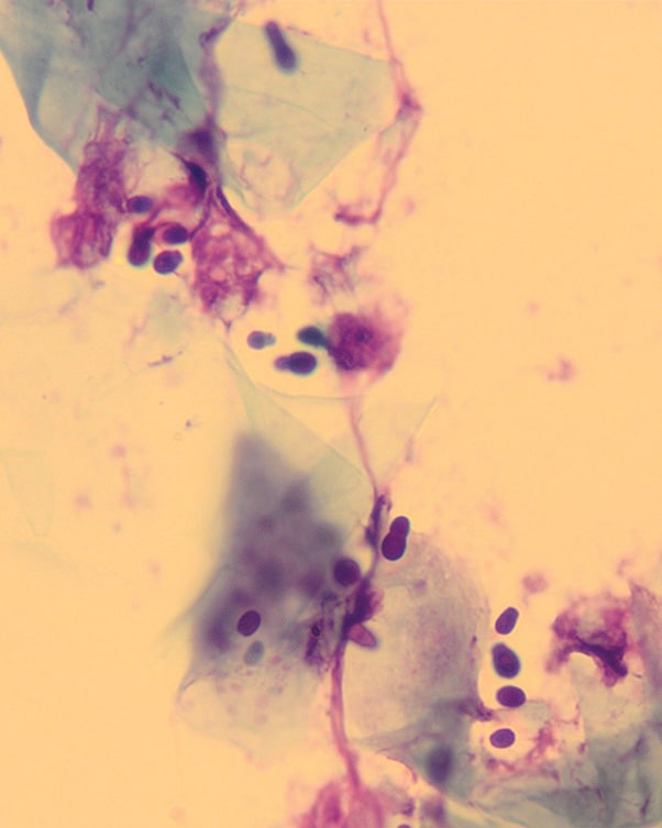 Malassezia Dermatitis | NDSR