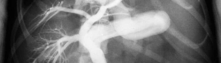 Portosystemic (liver) shunts - NDSR