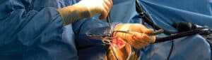 TPLO surgery for cruciate ligament rupture - NDSR