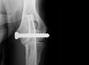 Humeral Condylar Fissures in Dogs (IOHC) | NDSR