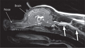 Syringomyelia - NDSR