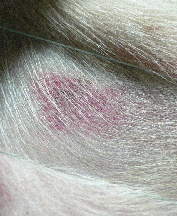 Cutaneous Vasculitis | NDSR