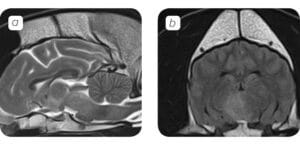 Meningoencephalitis of unknown origin (MUO) - NDSR