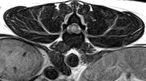 Intervertebral Disc Disease - NDSR