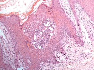 Skin biopsy: What is it and what does it involve - NDSR