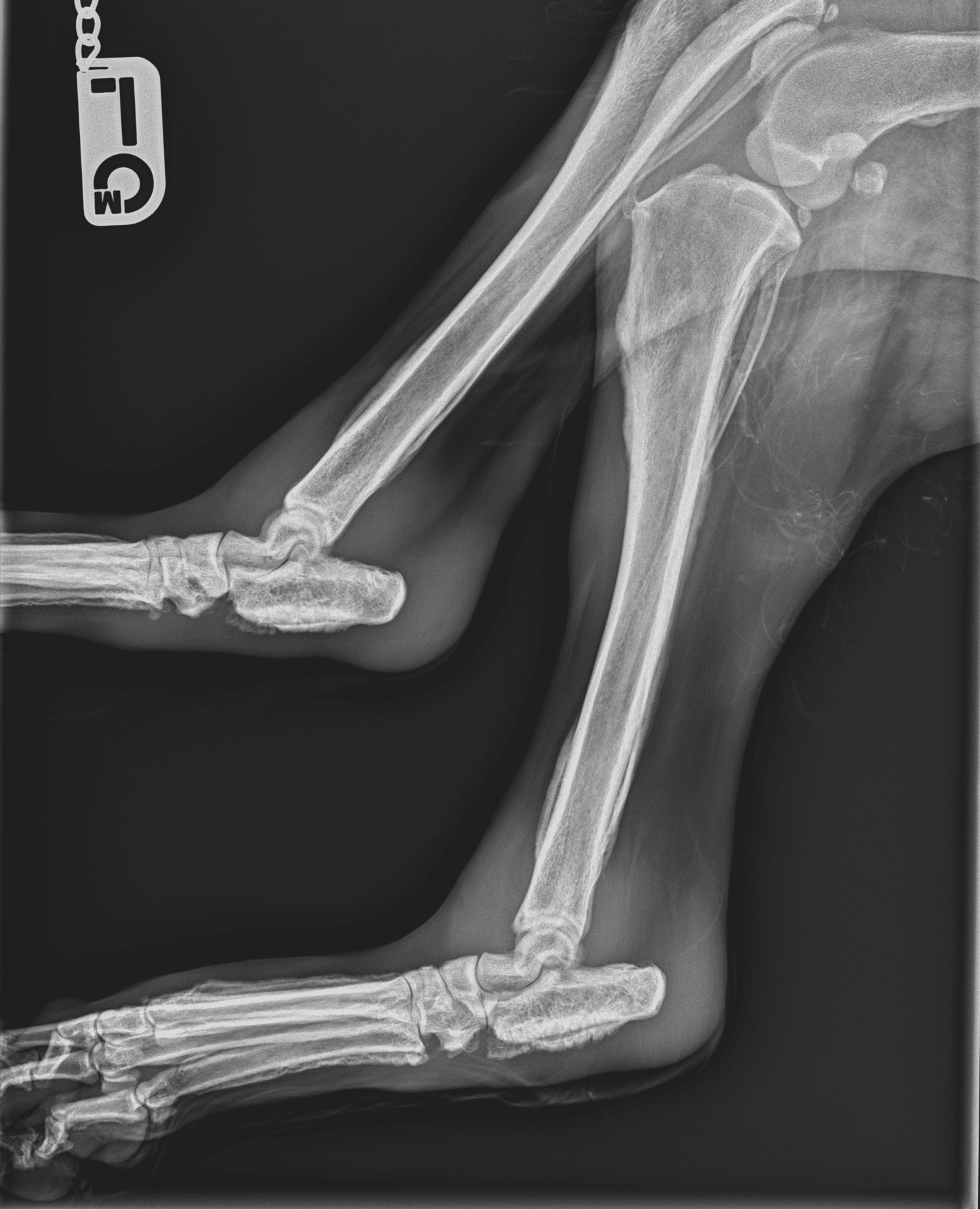 Hypertrophic osteopathy in 8-year-old Sybil - NDSR