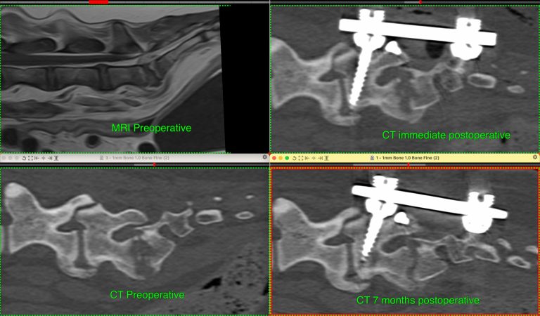 Pioneering Spinal Care Transforming Lives | NDSR | Redhill
